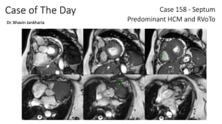 COD 158 - Septum Predominant HCM and RVoTo